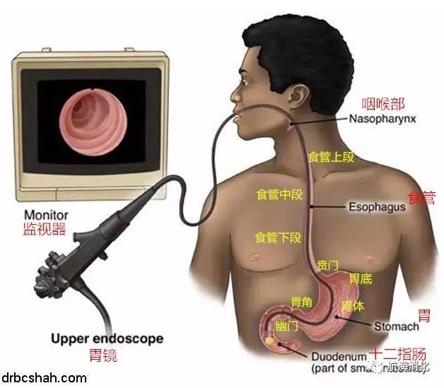 胃镜(四)你想知道胃镜下能看到什么吗?-咚咚肿瘤科